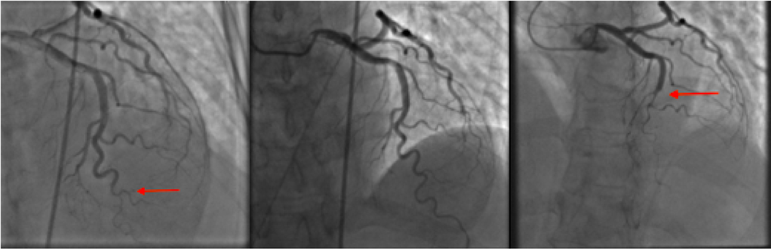 Recurrent Sudden Cardiac Arrests - MEDizzy Journal