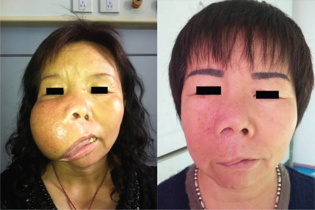 Surgical Correction Of Giant Maxillary Ossifying Fibroma