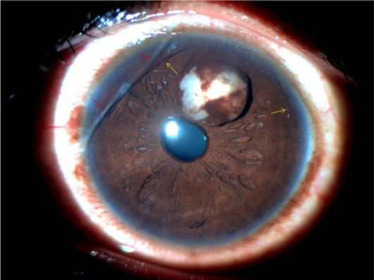 Intraocular Eyelashes And Iris Cyst Following Penetrating Eye Injury