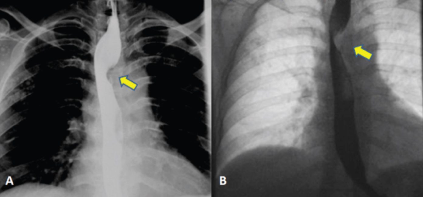 Dysphagia Lusoria- A Rare Cause Of Dysphagia - MEDizzy Journal
