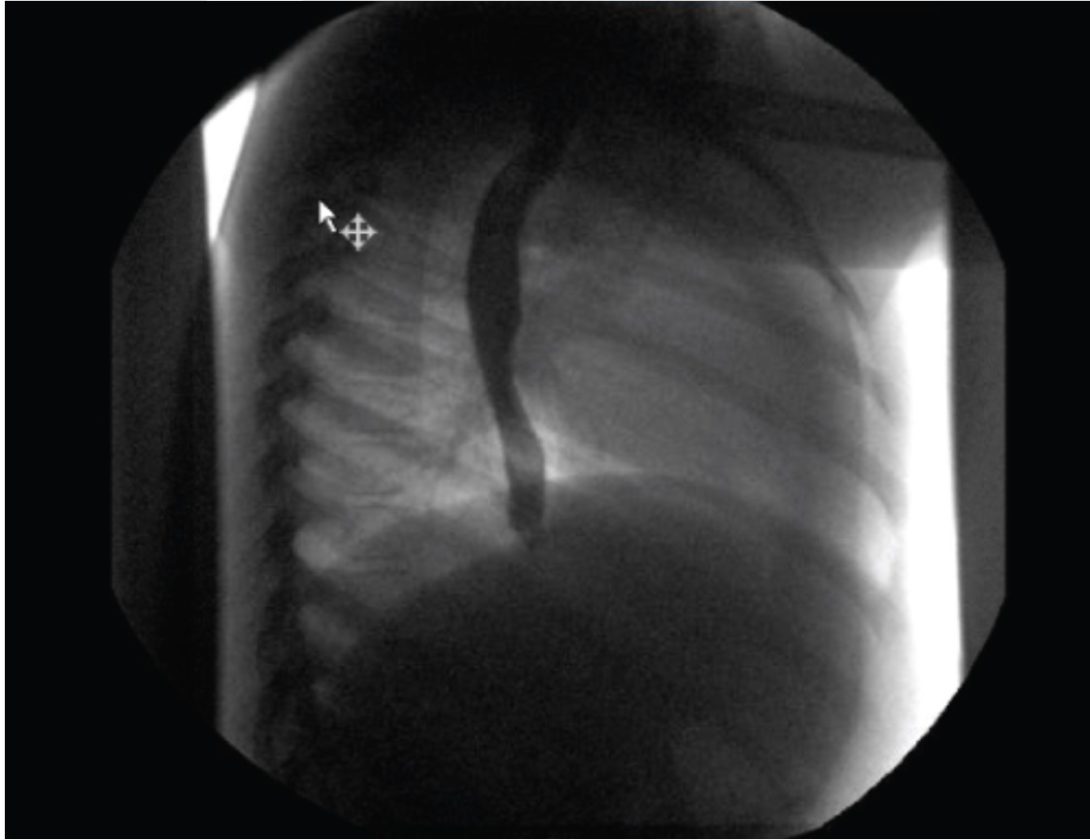 Complications Of Bleach Ingestion - MEDizzy Journal