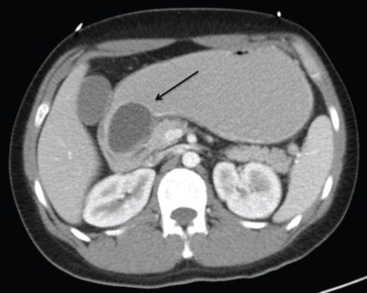 Gastric Duplication Cysts Medizzy Journal