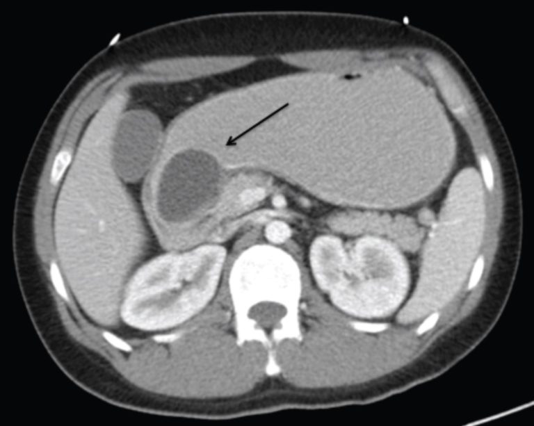 Gastric Duplication Cysts Medizzy Journal