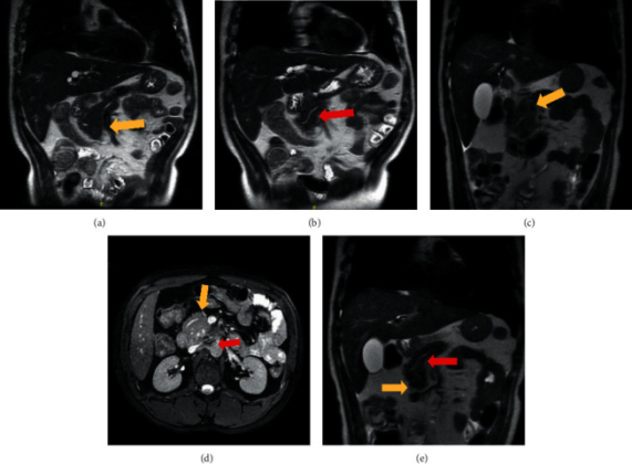 Late presentation of pancreatic divisum in a 52-year-old patient
