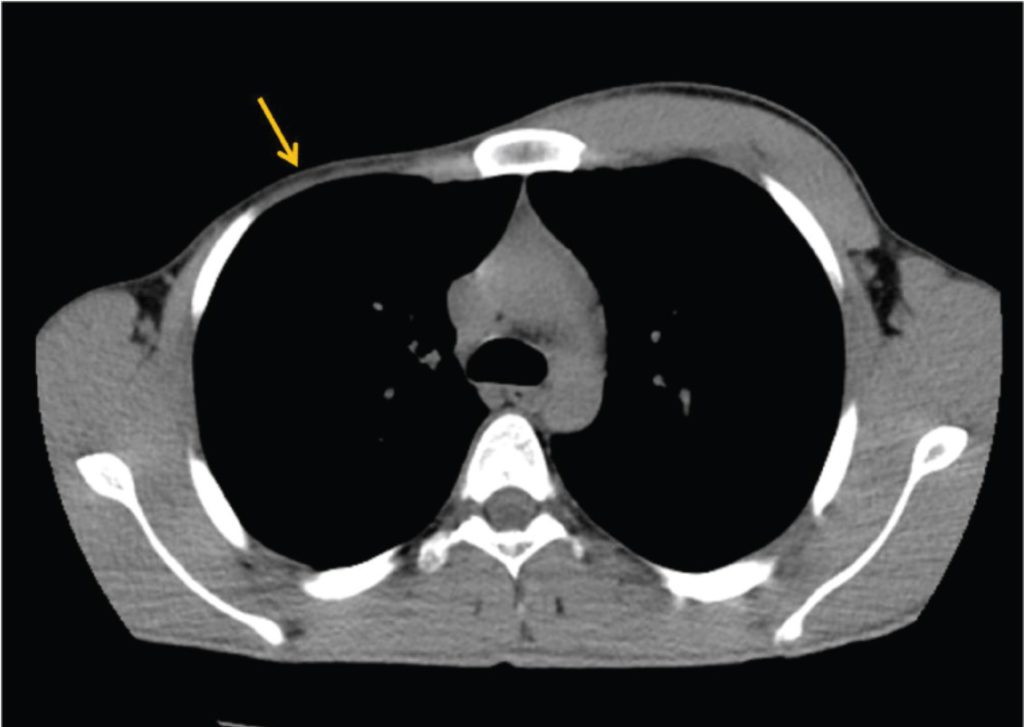 Poland Syndrome - Chest Wall Asymmetry - MEDizzy Journal