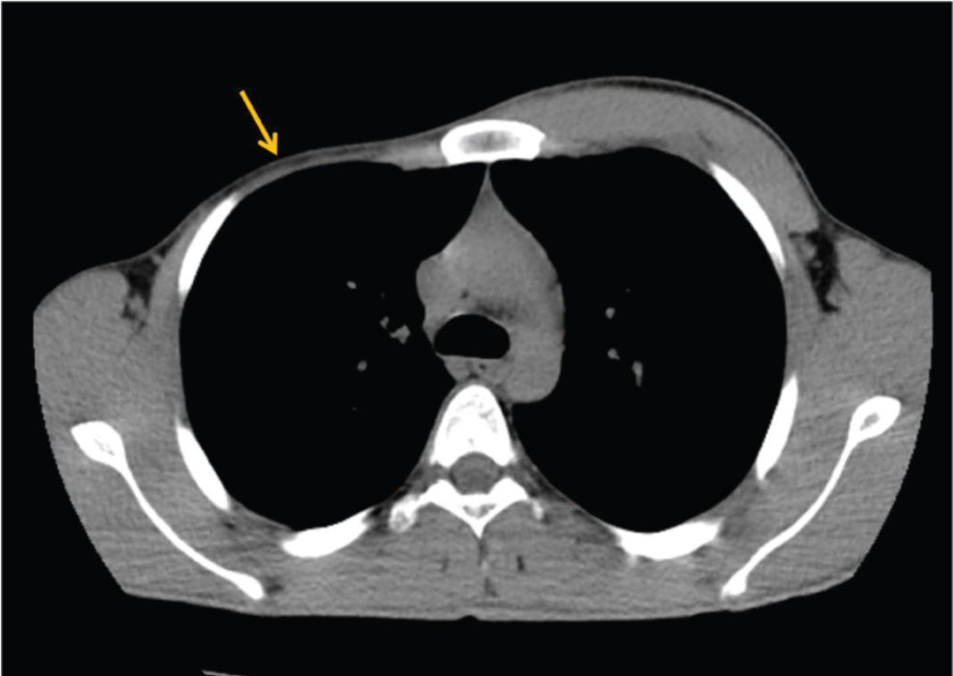 Poland Syndrome - Chest Wall Asymmetry - MEDizzy Journal