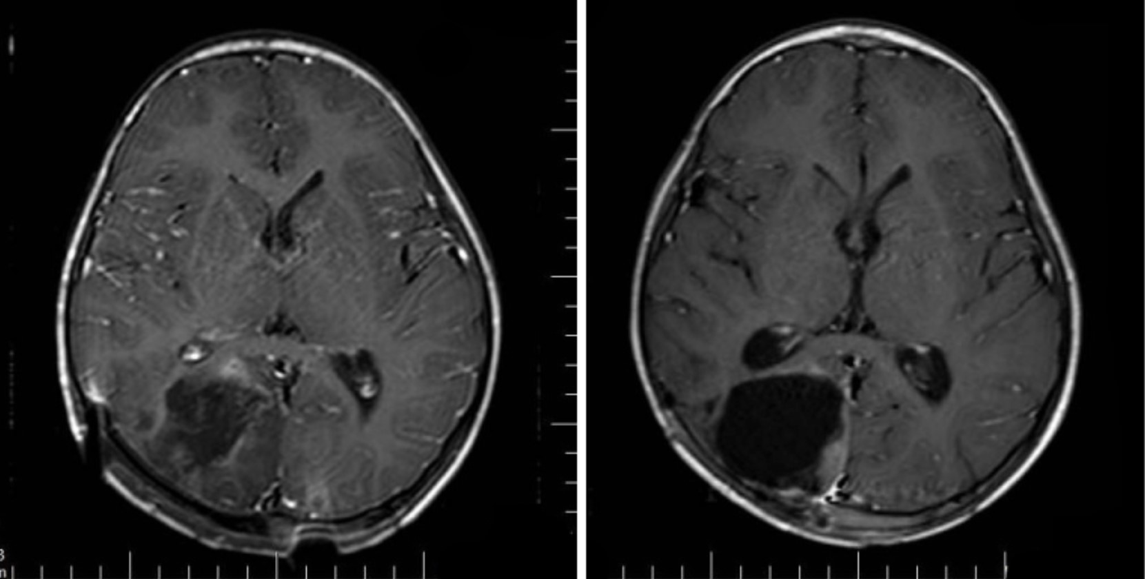 Hydatid Cyst In The Brain - MEDizzy Journal