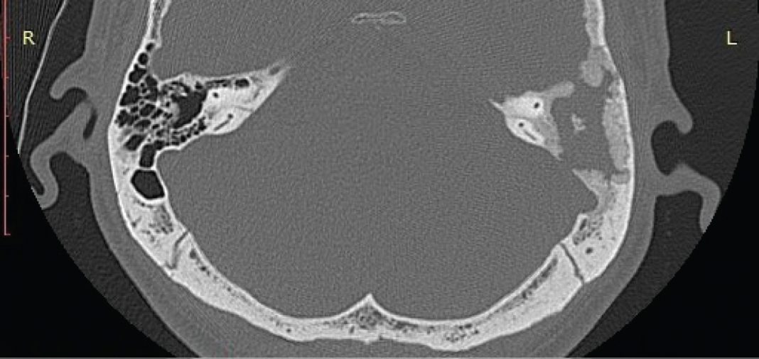 Gradenigo's Syndrome-Rare But Fatal - MEDizzy Journal