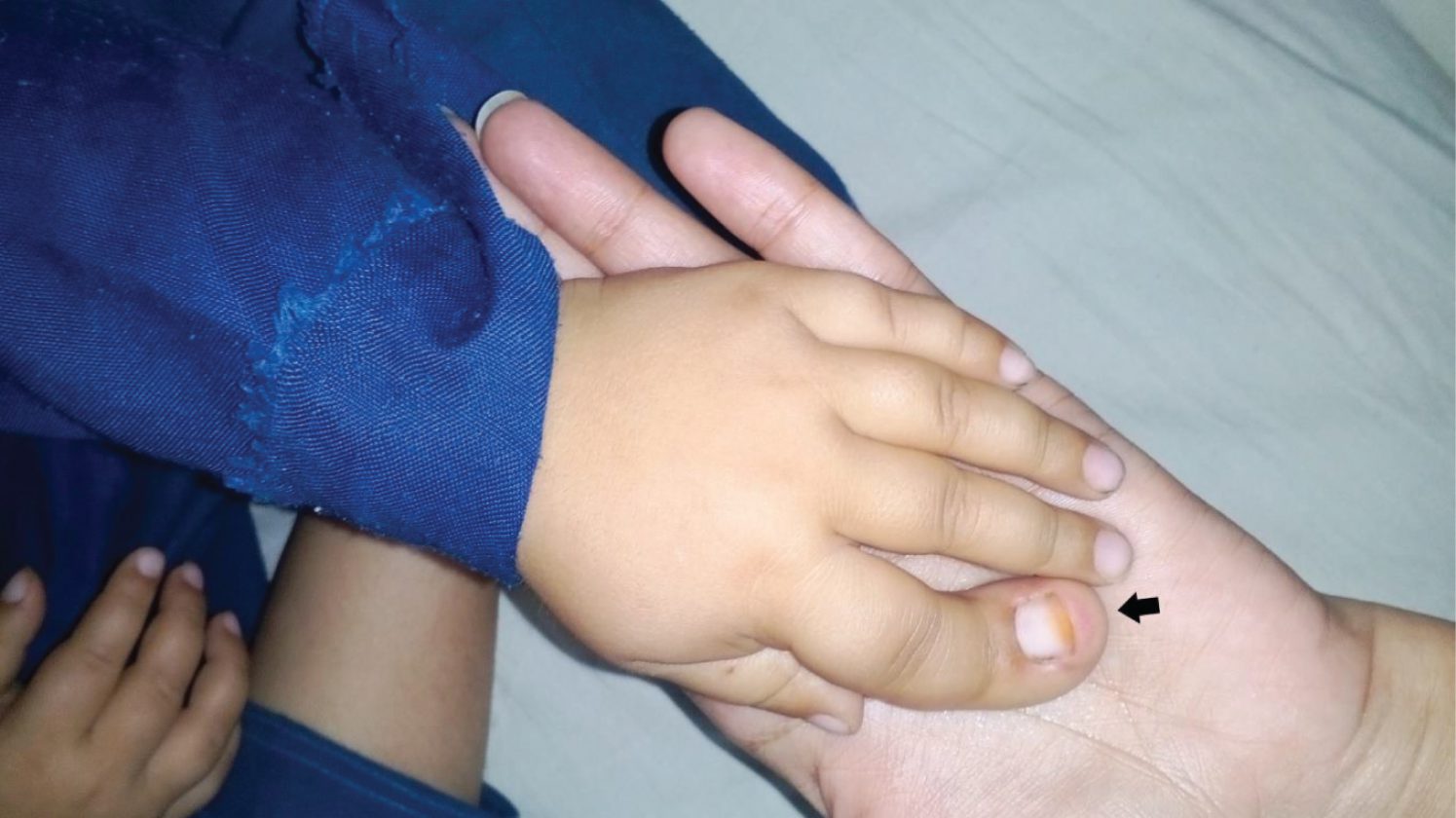 Macrodactyly Of The Hand Without Any Other Anomaly - MEDizzy Journal