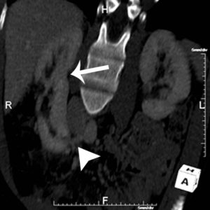 Triple Kidneys – A Unique Finding! - MEDizzy Journal