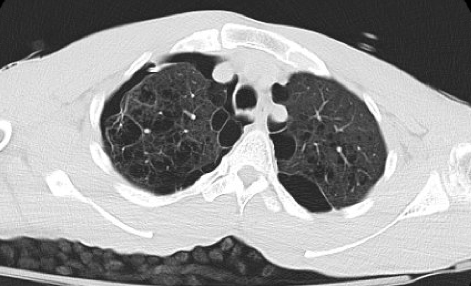 A Fatal Complication of Marijuana! - MEDizzy Journal