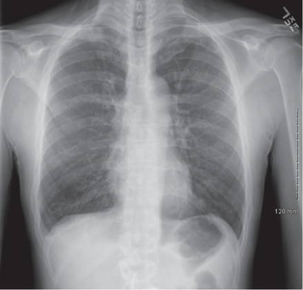 Allergic Bronchopulmonary Aspergillosis in 57-Year-Old