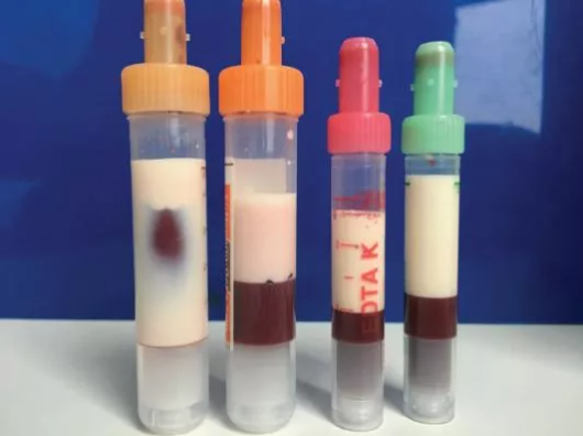 A Rare Case of Hypertriglyceridemia In 39-Year-Old