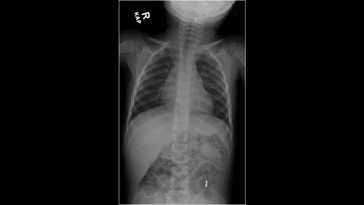 3-Year-Old Swallowed Magnet Beads that Got Stuck in His Throat