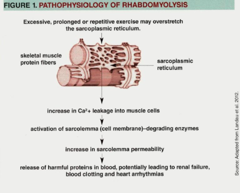 Rare but Life-threatening Muscle Injury After Exercise! - MEDizzy Journal