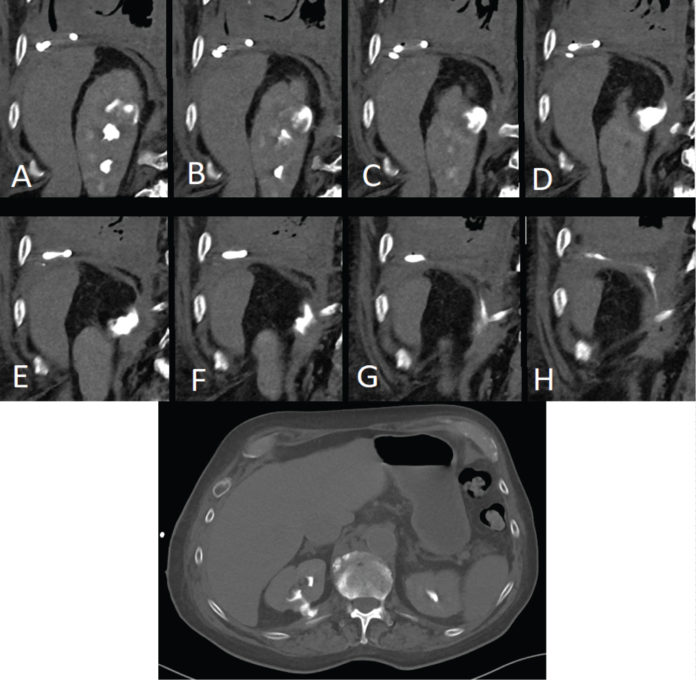 Urinothorax- Urine In The Chest Cavity! - MEDizzy Journal