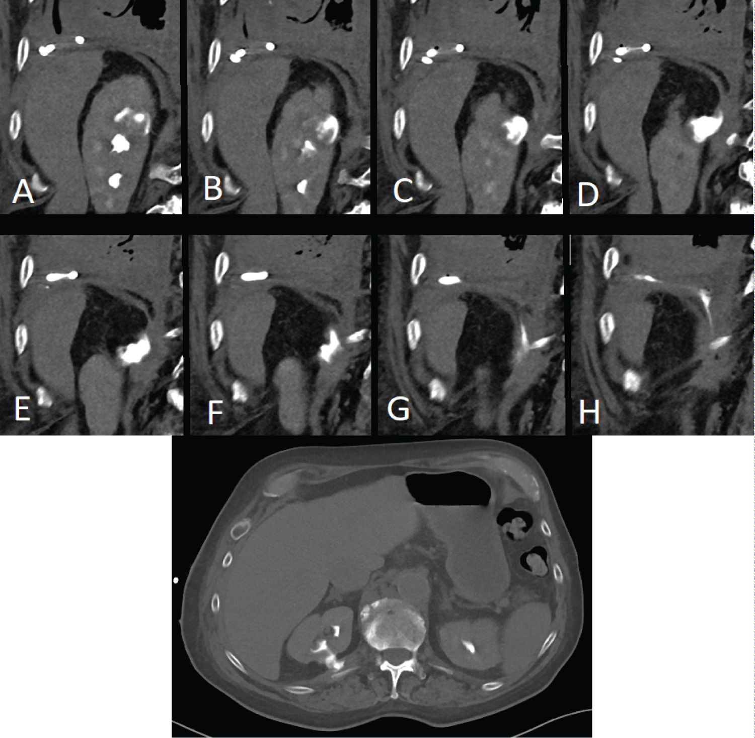 Urinothorax- Urine In The Chest Cavity! - MEDizzy Journal