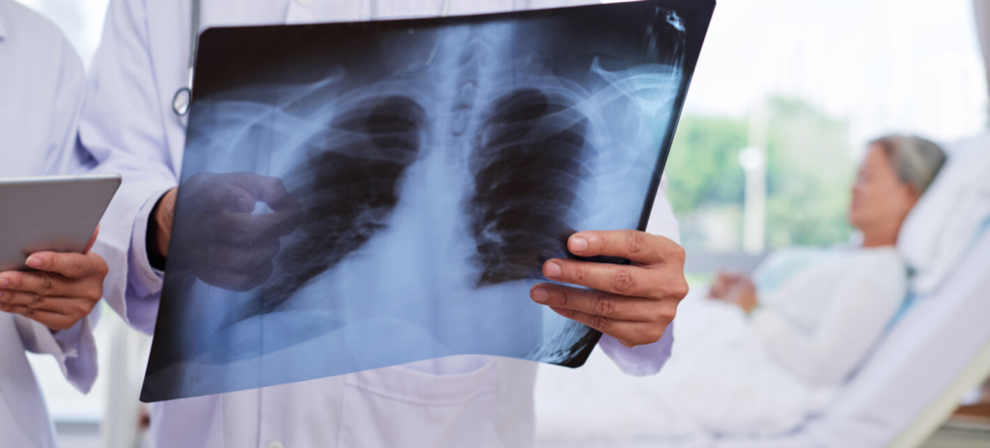 COVID-19 Caused Woman's Lungs Collapsed 5 Weeks After Recovering