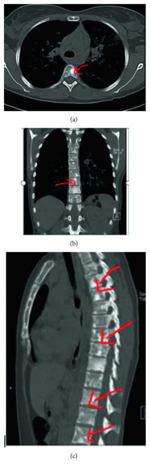 Pulmonary Adenocarcinoma Bone Metastasis in 30-Year-Old