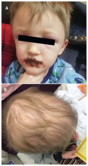 A Case of Severe Vitamin A Toxicity - MEDizzy Journal