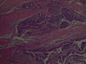 Heterotopic Pancreas in the Gallbladder of 49-Year-Old