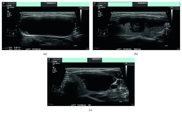 Multifocal Papillary Thyroid Cancer in Bilateral Thyroid Cysts