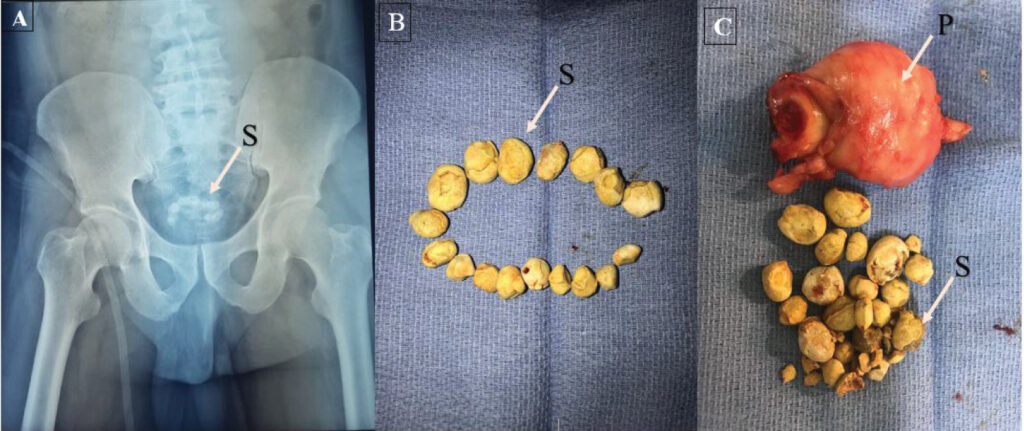Multiple Stones in the Bladder - MEDizzy Journal