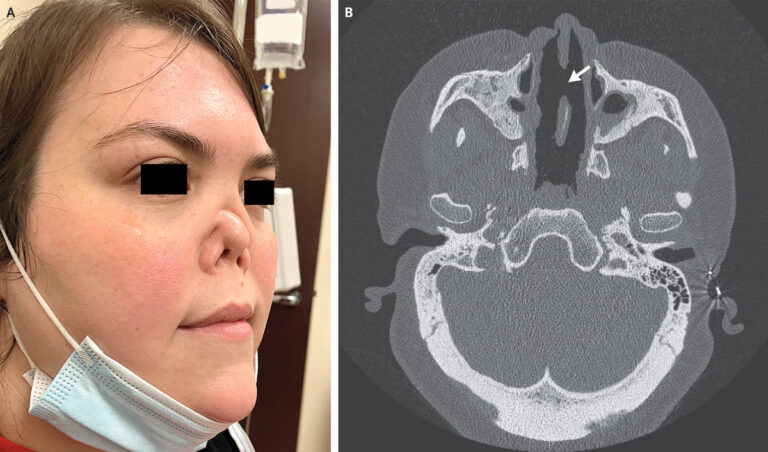 Deformity of the Nose - MEDizzy Journal