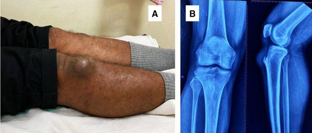Case of infrapatellar bursitis in 58-year-old clergyman