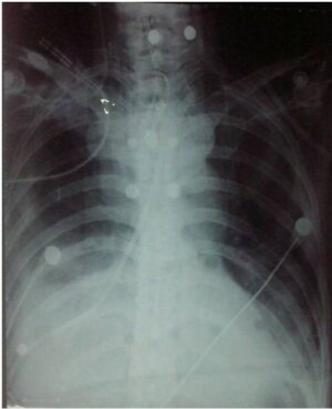 Wandering Nasogastric Tube - MEDizzy Journal