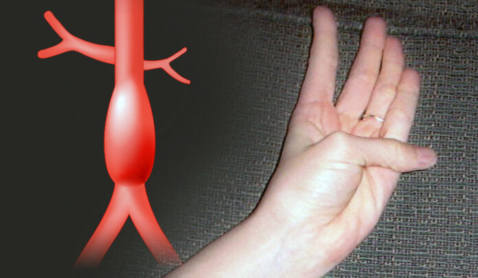 A Simple Test that can Catch an Aortic Aneurysm - MEDizzy Journal