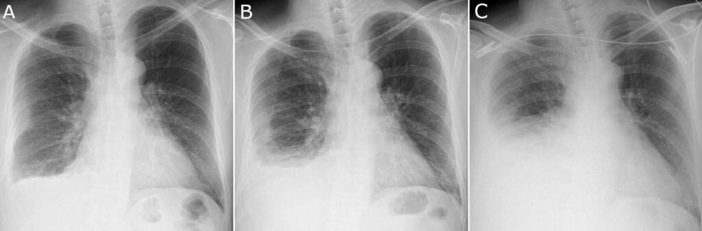Cough-induced rib fracture in 44-year-old post infectious cough
