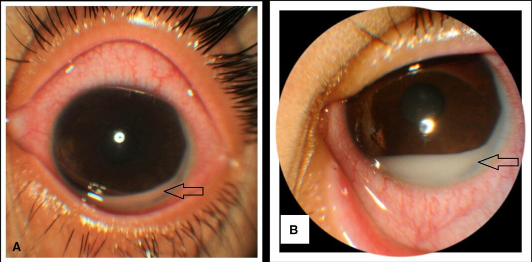 Case of Masquerade Uveitis with Hypopyon in 5-Year-Old