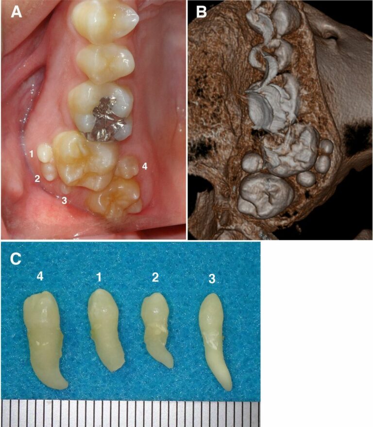 Case of Supernumerary Teeth in Non-Syndromic Patient