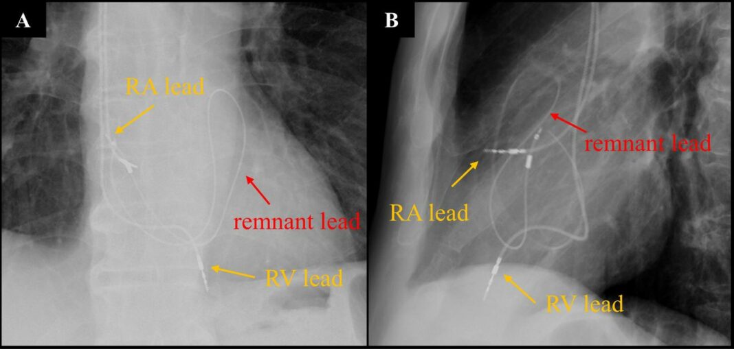 72-Year-Old's Pacemaker Dislodged While Playing Tennis