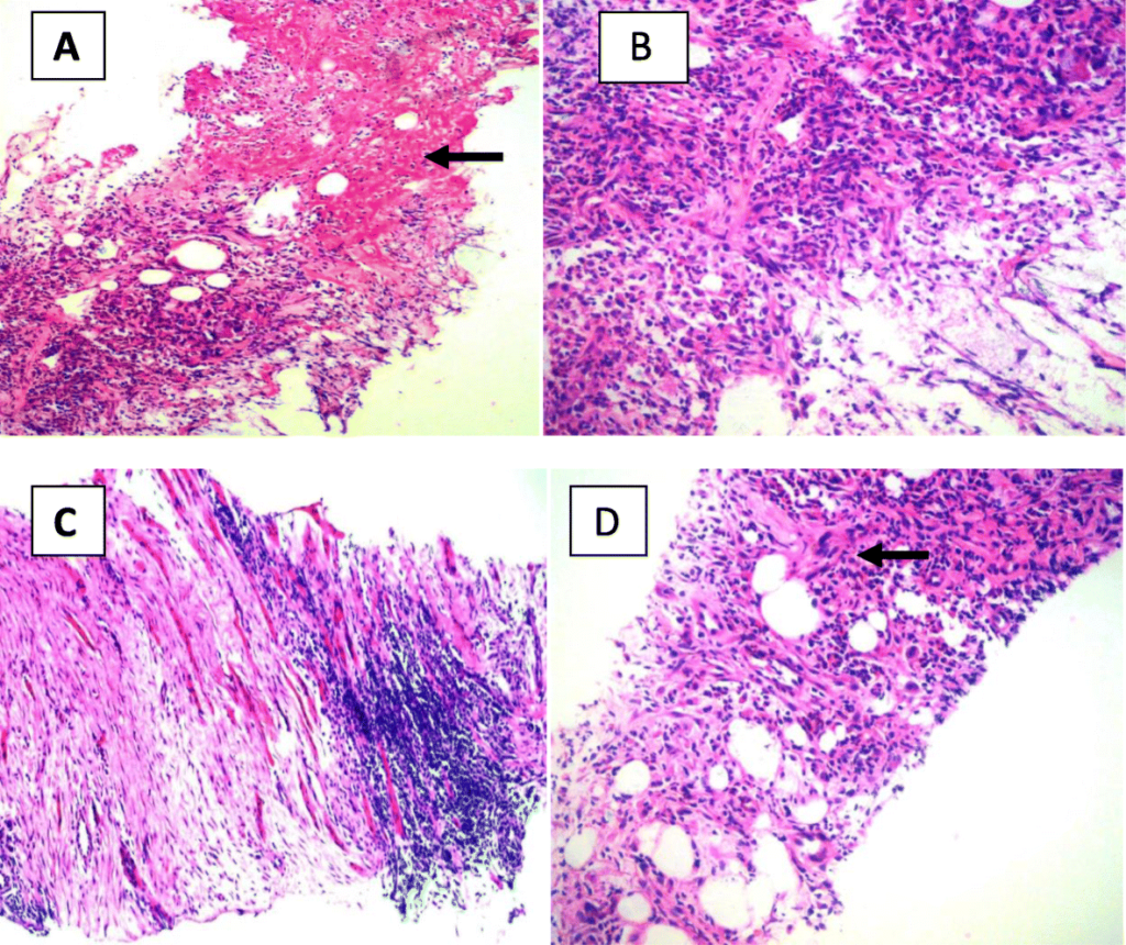 Infective Myositis, a Secondary Manifestation of Melioiodosis