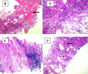Infective Myositis, a Secondary Manifestation of Melioiodosis