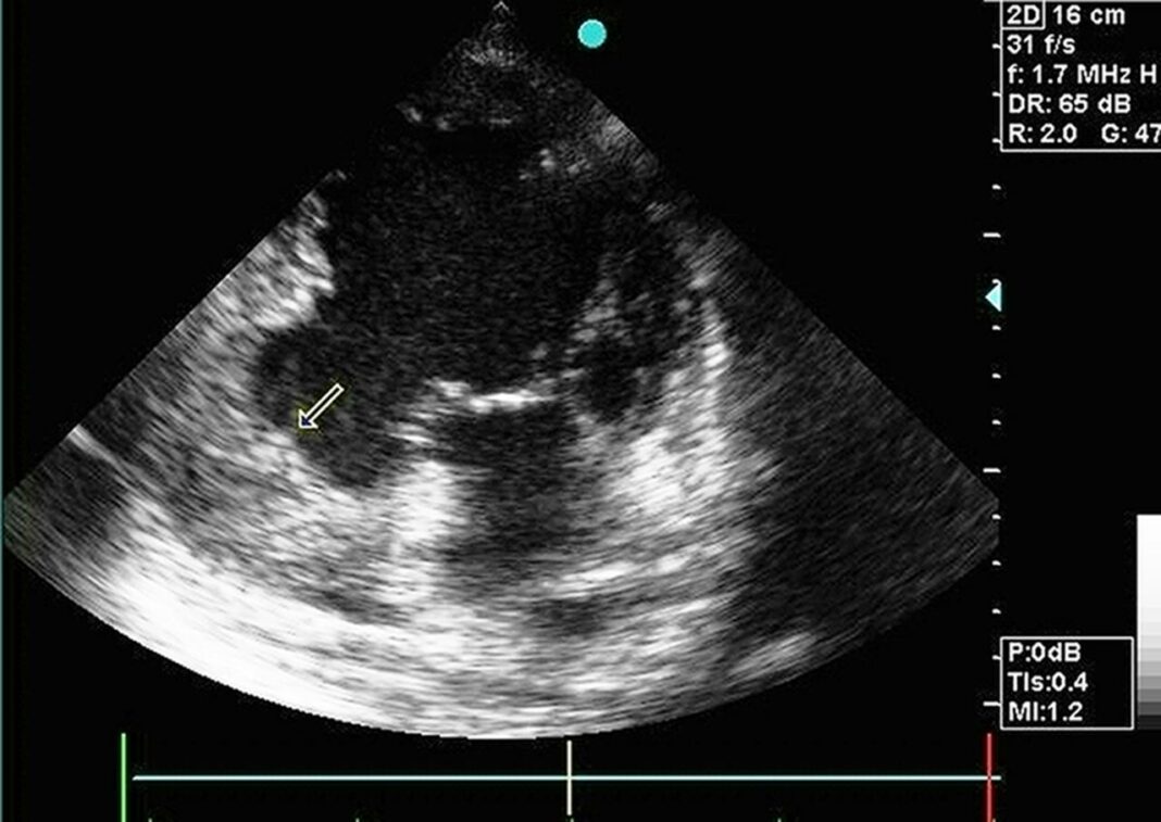 Rare case of large basal inferior wall aneurysm