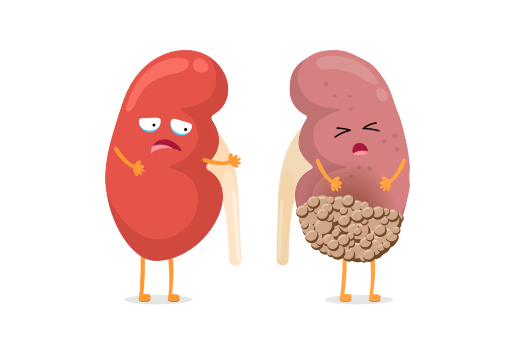 Renal carcinoma