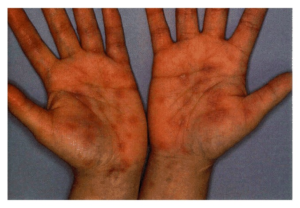 Secondary Syphilis with Symmetric, Dusky Red Rash