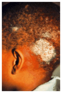 Case of Tinea capitis in 11-year-old - MEDizzy Journal