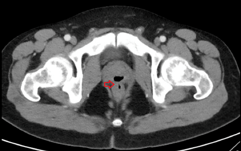 Rare case of rectal-prostate fistula