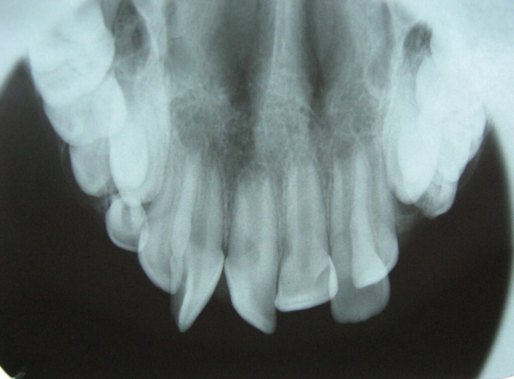 Case of supernumerary maxillary incisor teeth