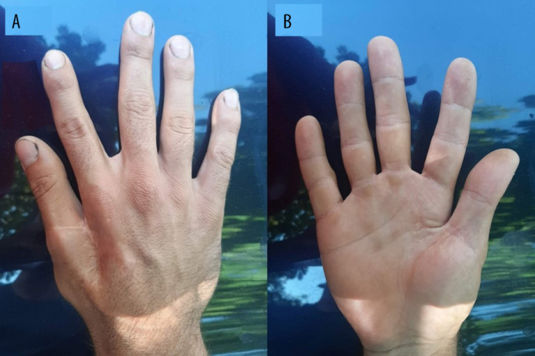 Severe Post-Traumatic First Web Space Contracture