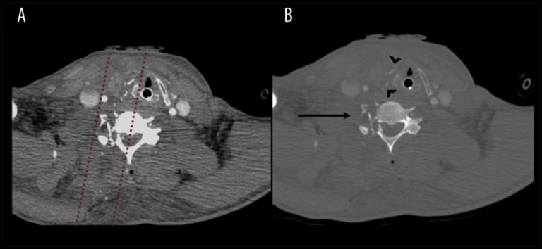 Traumatic Thyroid Gland Hypoperfusion/Devascularization
