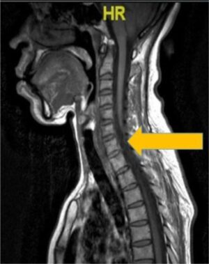 Syringomyelia Presenting with Optic Neuropathy - MEDizzy Journal