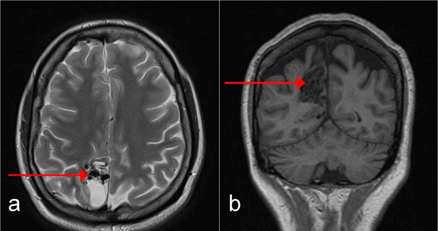 Cerebral Arteriovenous Malformation in Pregnancy- A Rare Case - MEDizzy ...