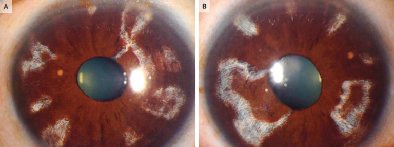 Case of Iris Atrophy in Patient with Sickle Cell Disease