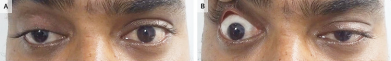 Curtain sign and myasthenia gravis
