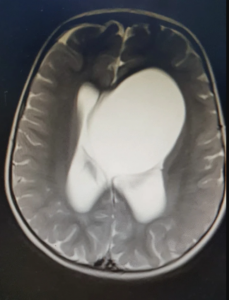 Head Nodding due to Arachnoid Cyst- MEDizzy Journal